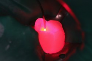 Ozon statt Bohrer: PAD und HealOzone - ZahnMedizinPraxis Stockleben